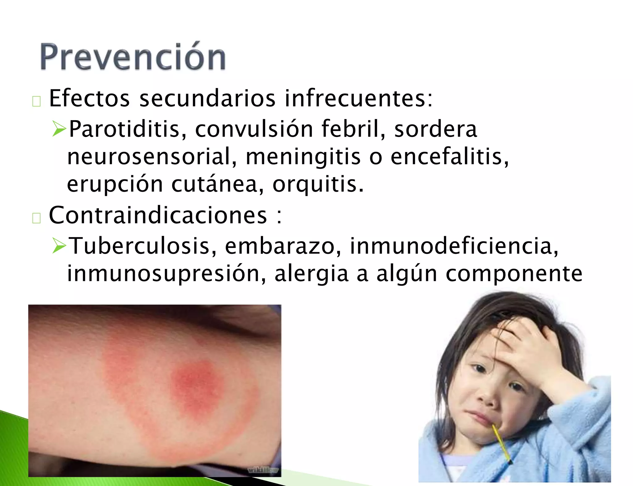 Parotiditis viral | PPT