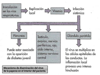 Parotiditis viral (paperas) | PPTX