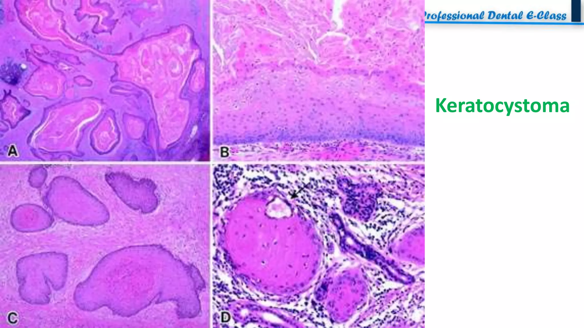 Parotid Keratocystoma | Professional Dental E-Class | PPTX | Ear, Nose ...