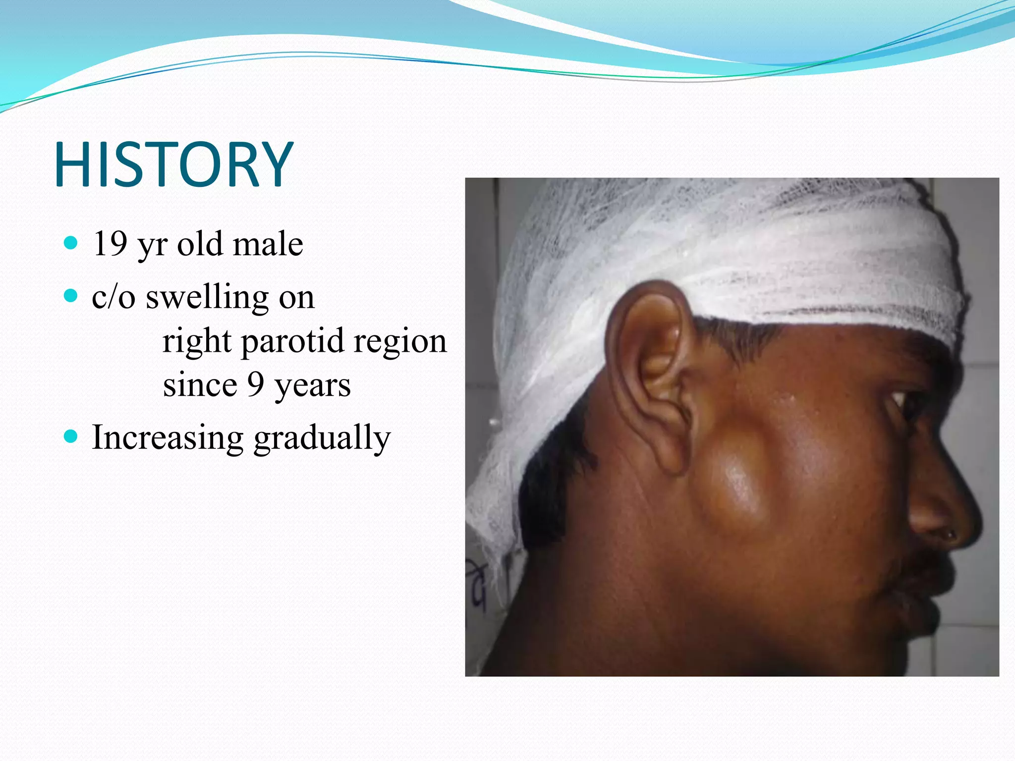 Parotid ppt | PPTX