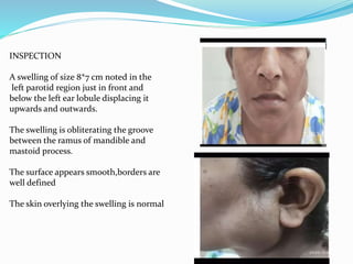 PAROTID SWELLING ps.pptx
