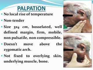 Parotid tumour asicon 2017 jaipur | PPTX