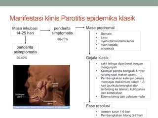 what do you mean i need minimum of 40 letter?Parotitis.pptx