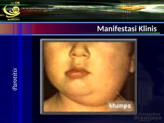 Waspada parotitis/mumps dan pencegahanya.ppt