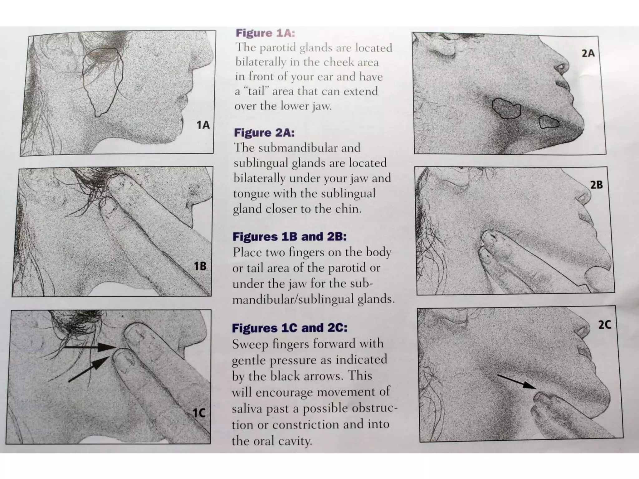 Management of Parotitis | PPTX