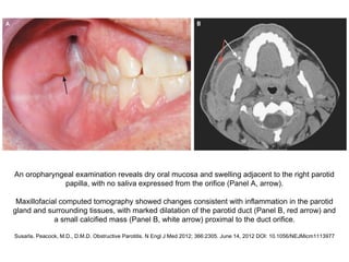 Management of Parotitis | PPTX