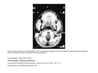 Management of Parotitis | PPTX