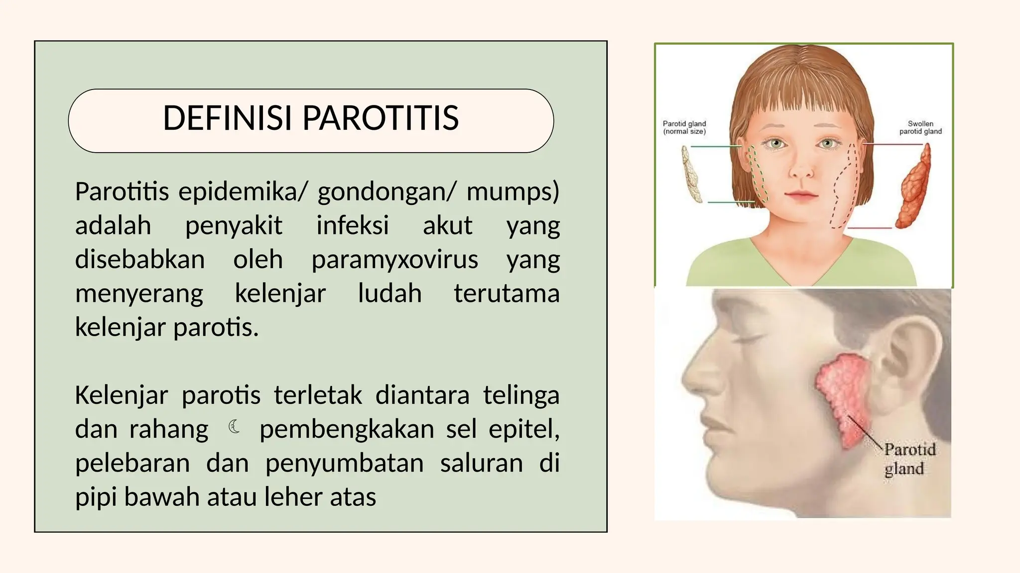 Parotitis epidemika, gondongan mumps in pediatric | PPT