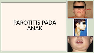 Parotitis epidemika, gondongan mumps in pediatric | PPTX