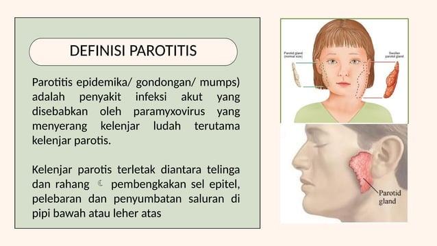 Parotitis epidemika, gondongan mumps in pediatric | PPT