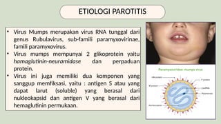 Parotitis epidemika, gondongan mumps in pediatric | PPTX