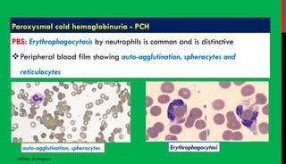 Paroxysmal cold hemoglobinuria -PCH | PDF