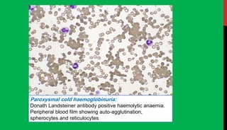 Paroxysmal cold hemoglobinuria -PCH | PDF