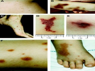 Paroxysmal nocturnal hemoglobinuria | PPTX