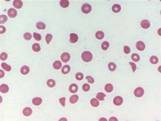 Paroxysmal Nocturnal Hemoglobinuria Blood Smear