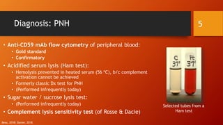 Paroxysmal Nocturnal Hemoglobinuria (PNH) - A Pathologic Survey | PPTX