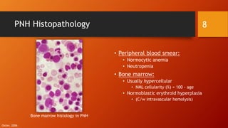 Paroxysmal Nocturnal Hemoglobinuria Blood Smear