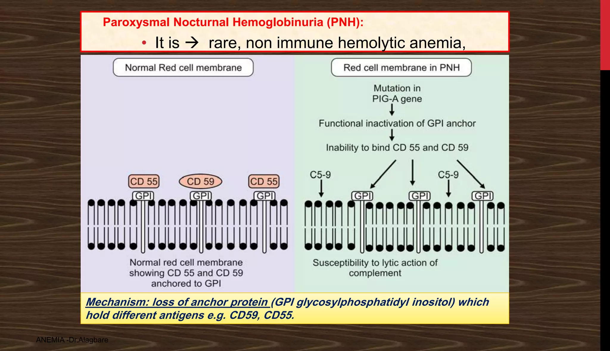 Paroxysmal nocturnal hemoglobinuria (PNH) | PDF