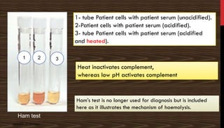 Paroxysmal nocturnal hemoglobinuria (PNH) | PDF