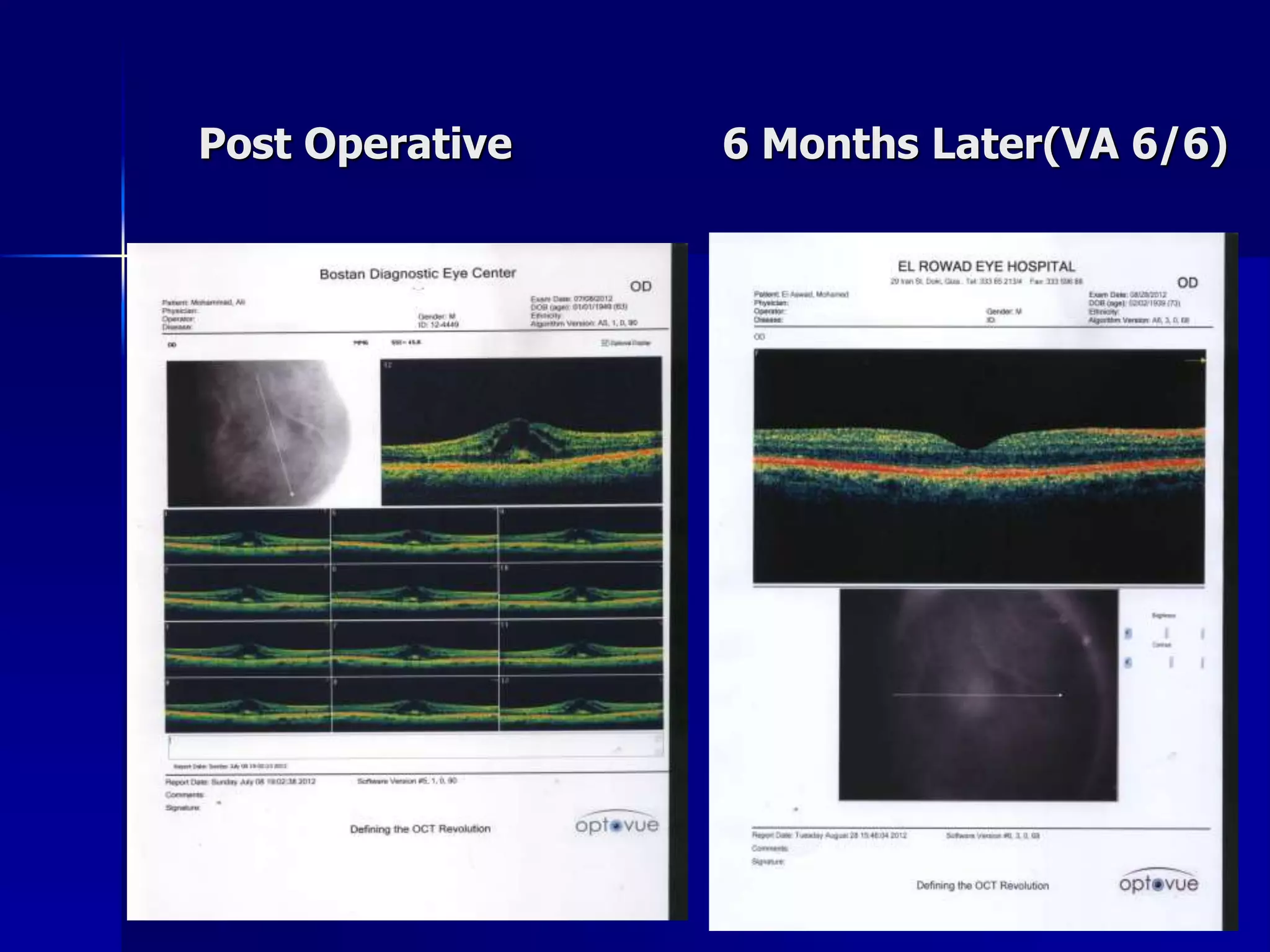 EMERGENCY PARS PLANA VITRECTOMY FOR ACUTE POST - CATARACT ENDOPHTHALMITIS WHEN ? , AND HOW ? | PPTX