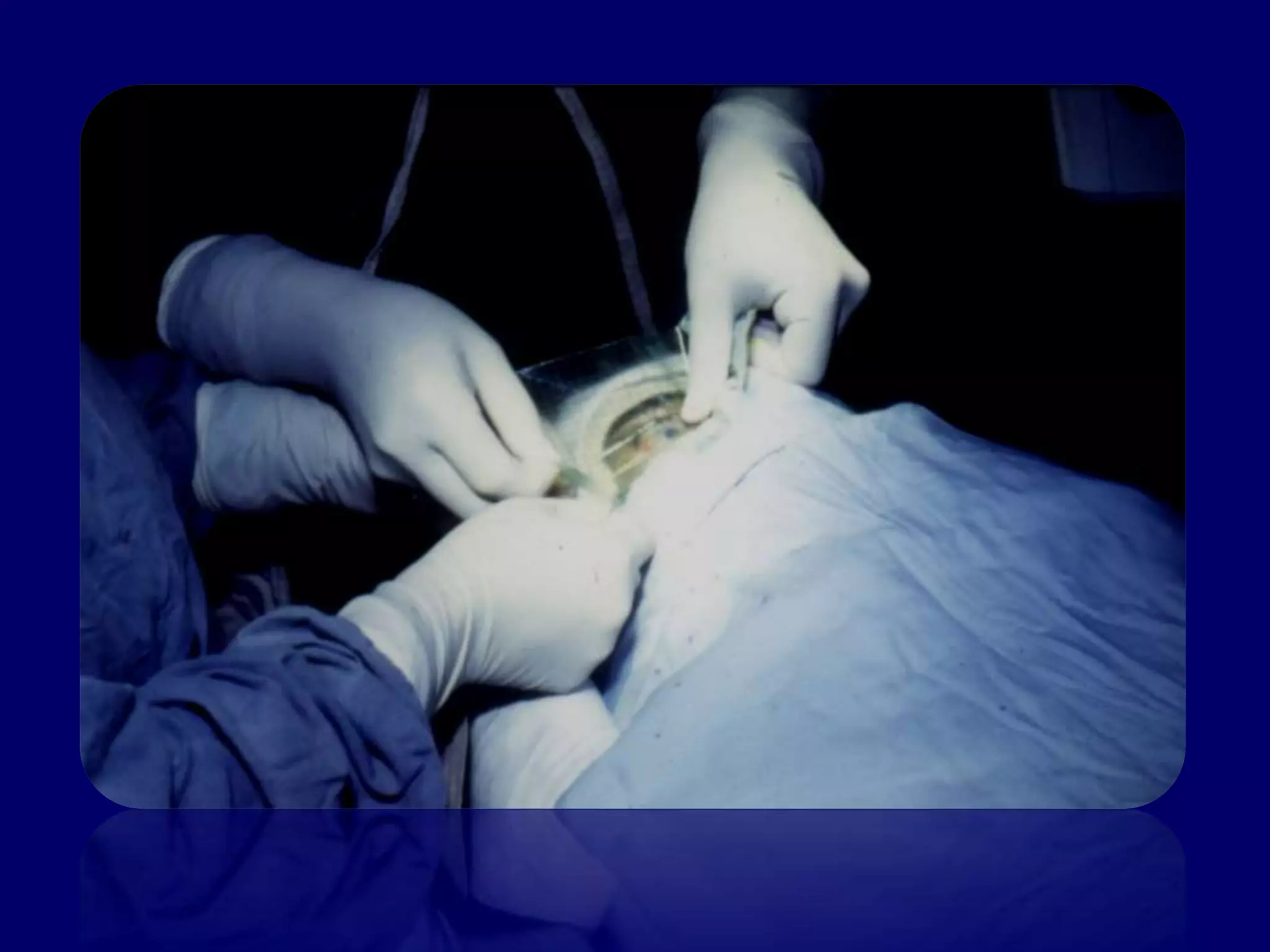 EMERGENCY PARS PLANA VITRECTOMY FOR ACUTE POST - CATARACT ...