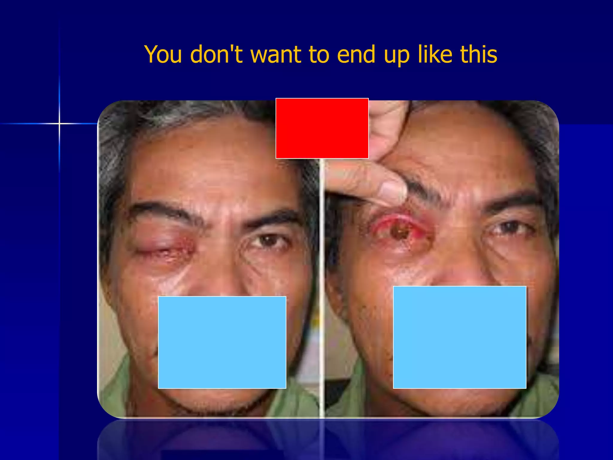 EMERGENCY PARS PLANA VITRECTOMY FOR ACUTE POST - CATARACT ...