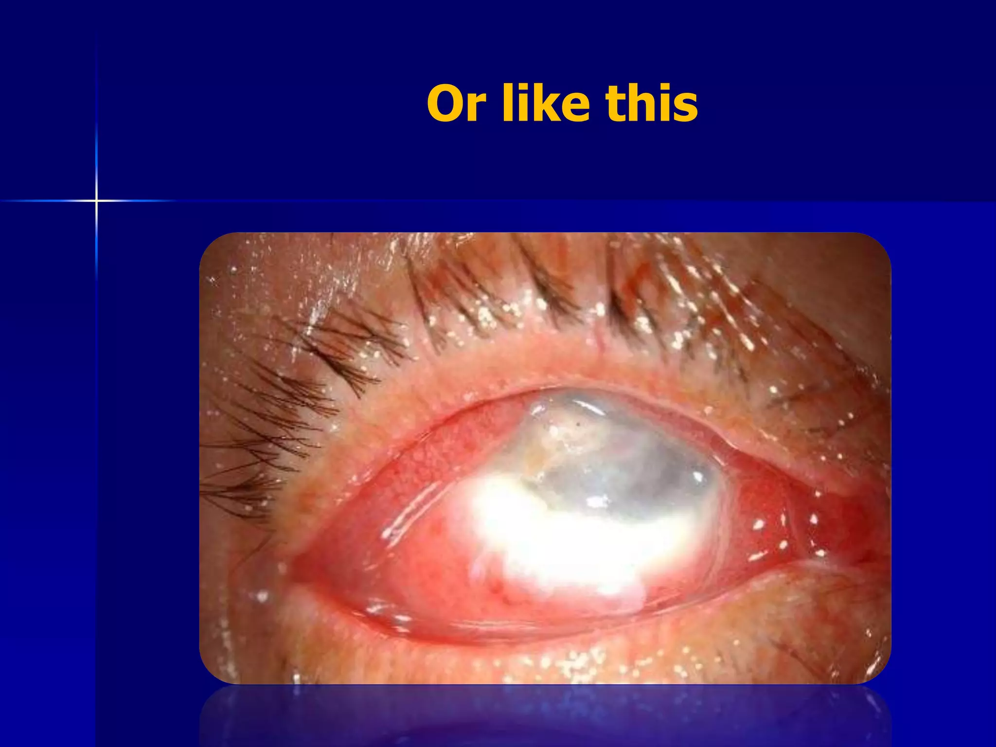 EMERGENCY PARS PLANA VITRECTOMY FOR ACUTE POST - CATARACT ...
