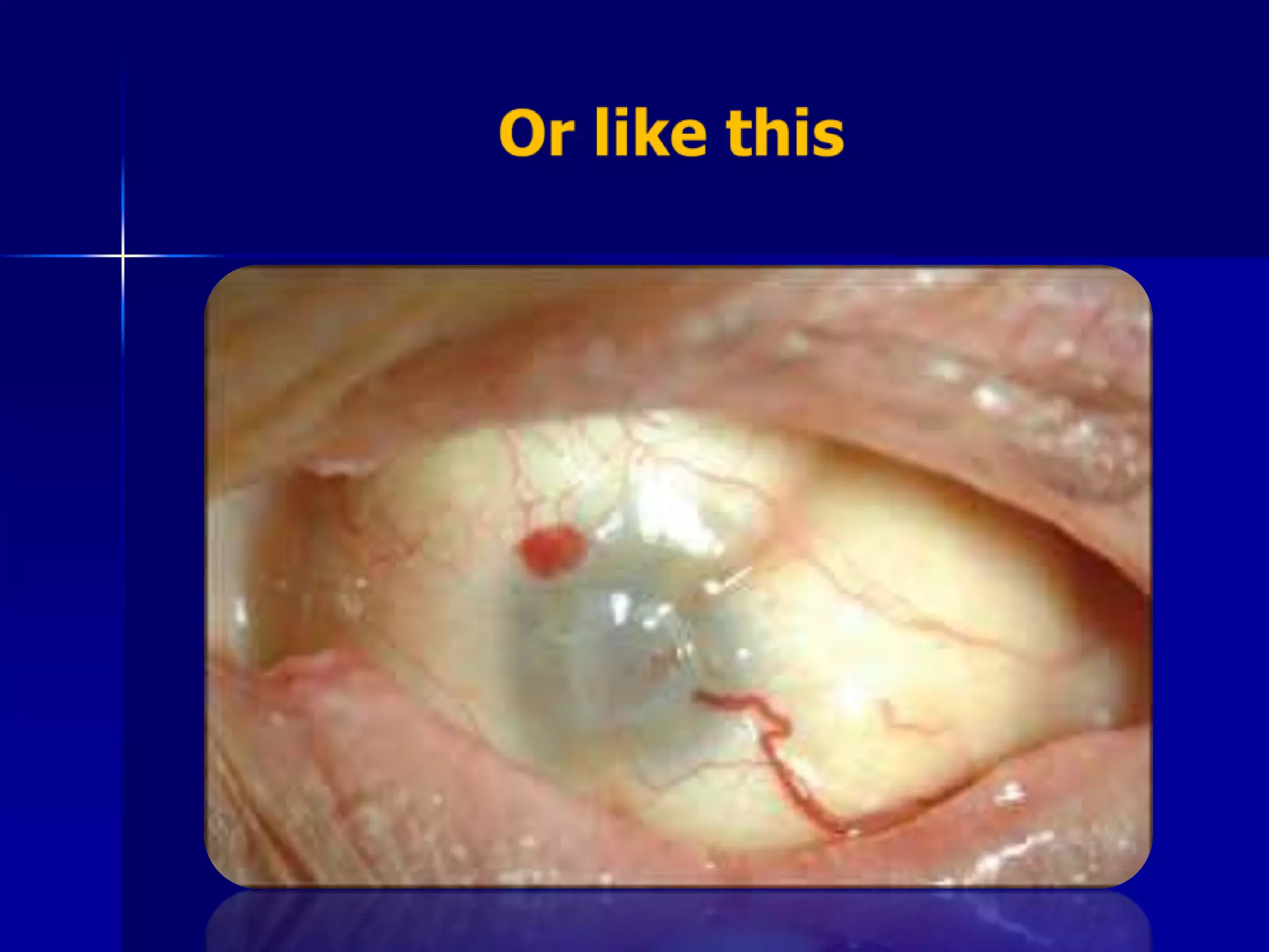 EMERGENCY PARS PLANA VITRECTOMY FOR ACUTE POST - CATARACT ...