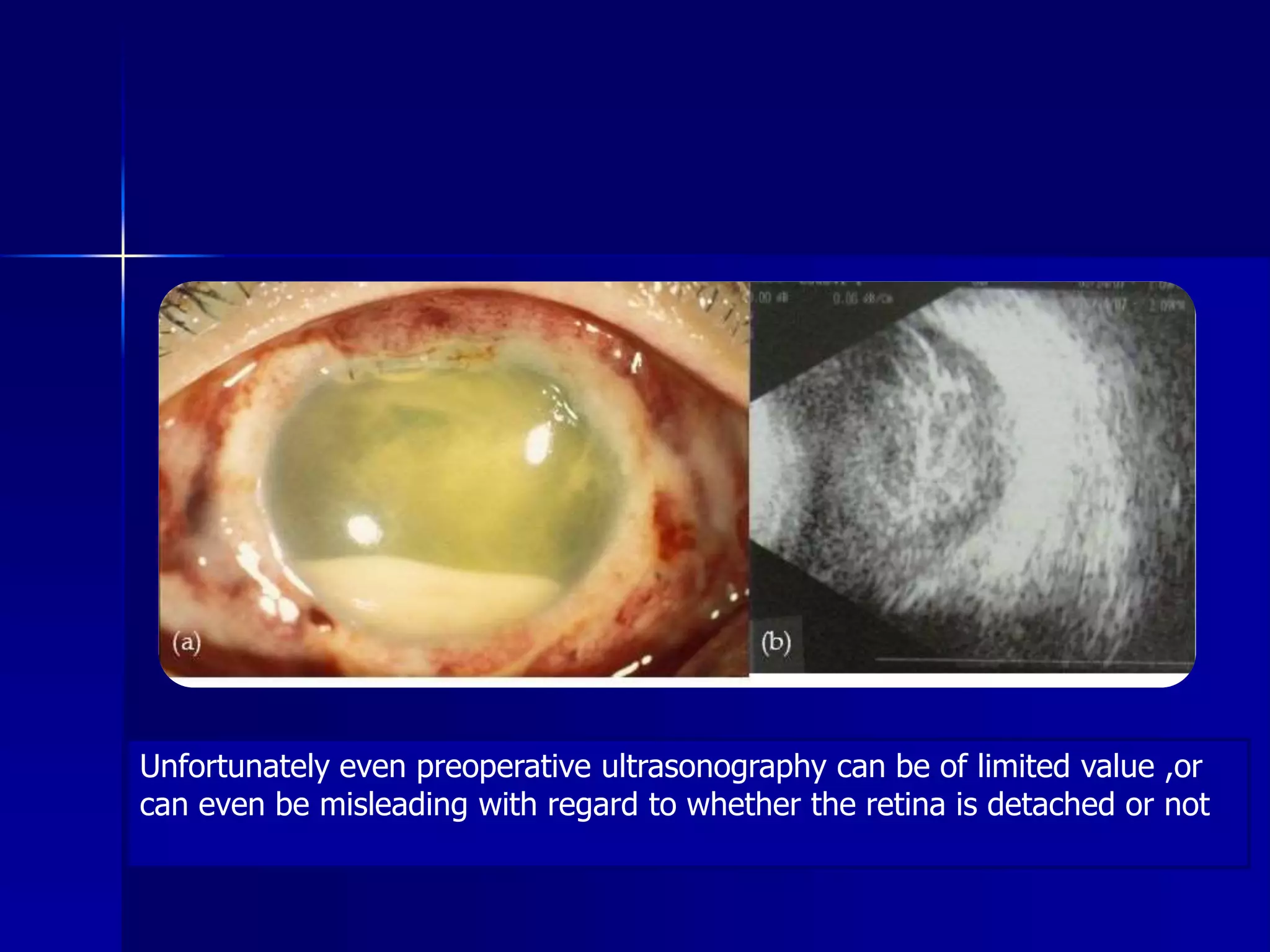 EMERGENCY PARS PLANA VITRECTOMY FOR ACUTE POST - CATARACT ...