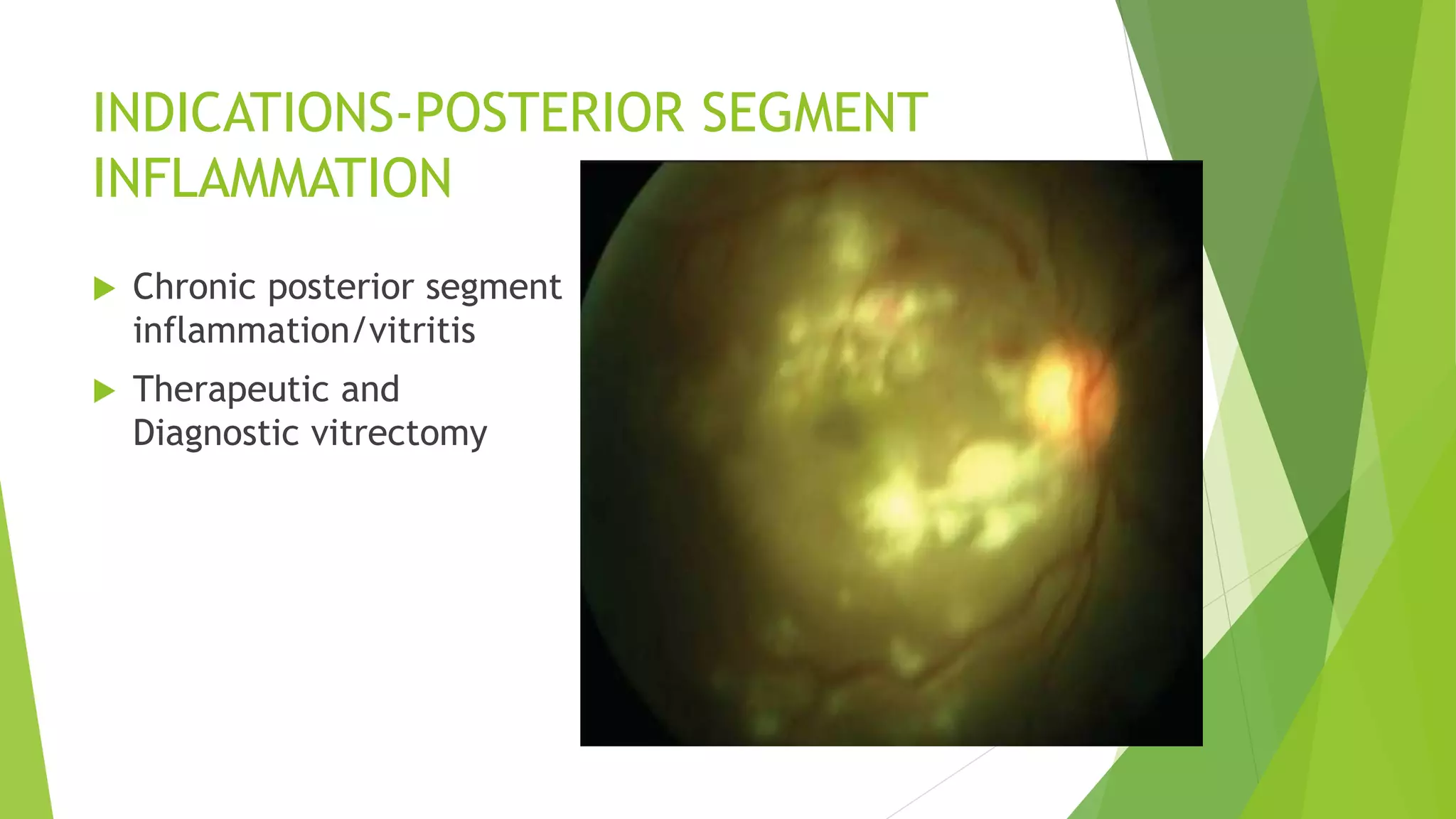 PARS PLANA VITRECTOMY FOR LENS DROP.pptx