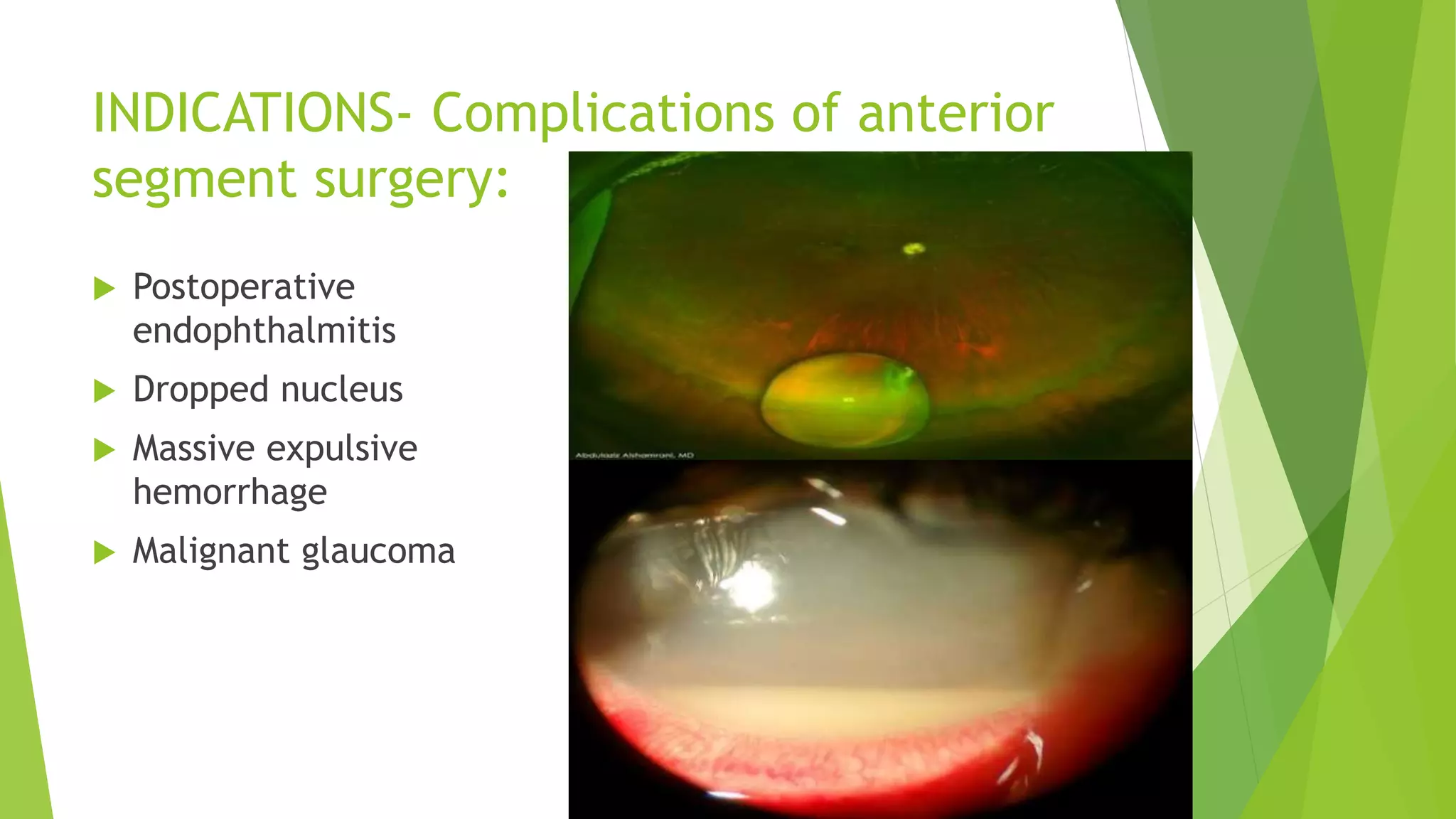 PARS PLANA VITRECTOMY FOR LENS DROP.pptx