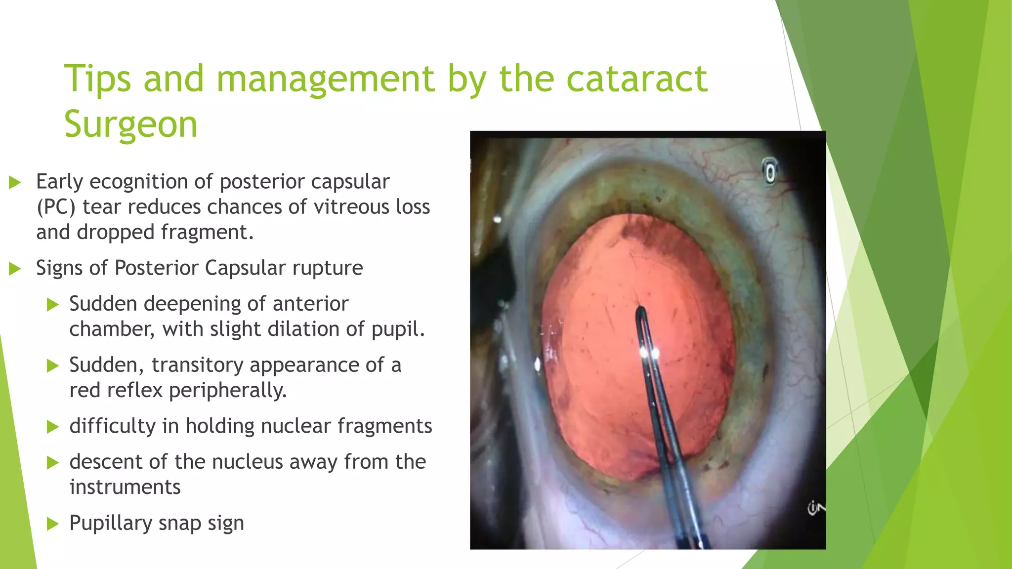 PARS PLANA VITRECTOMY FOR LENS DROP.pptx