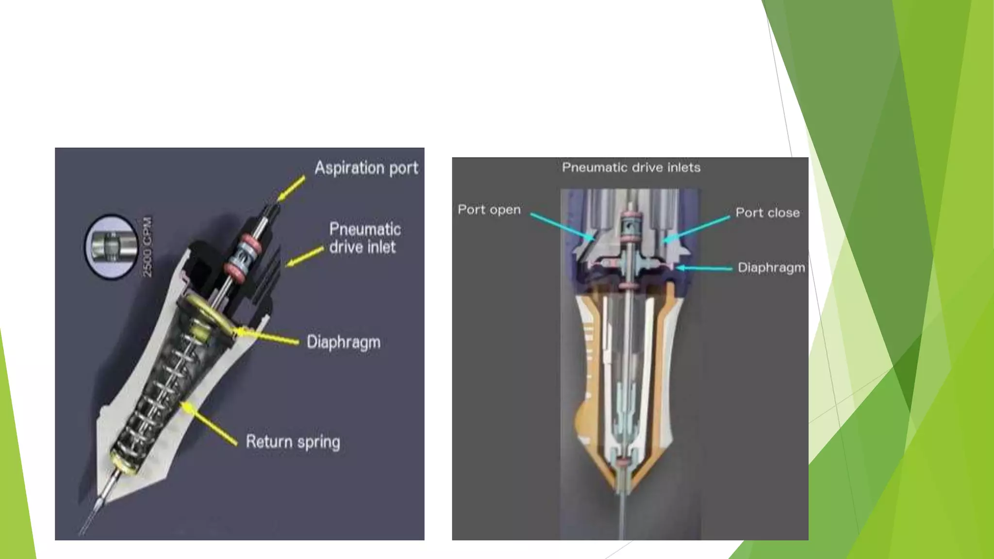 PARS PLANA VITRECTOMY FOR LENS DROP.pptx