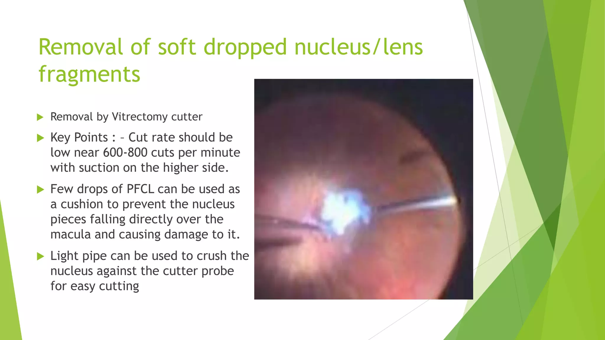 PARS PLANA VITRECTOMY FOR LENS DROP.pptx