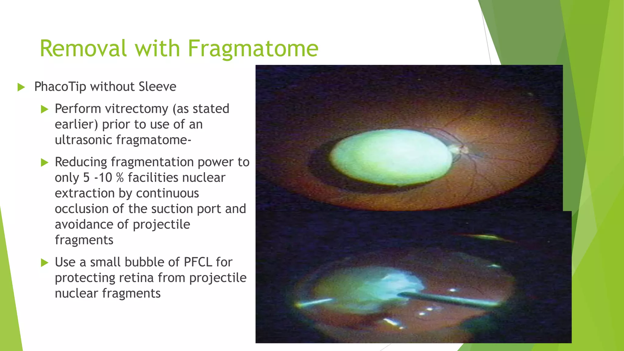 PARS PLANA VITRECTOMY FOR LENS DROP.pptx