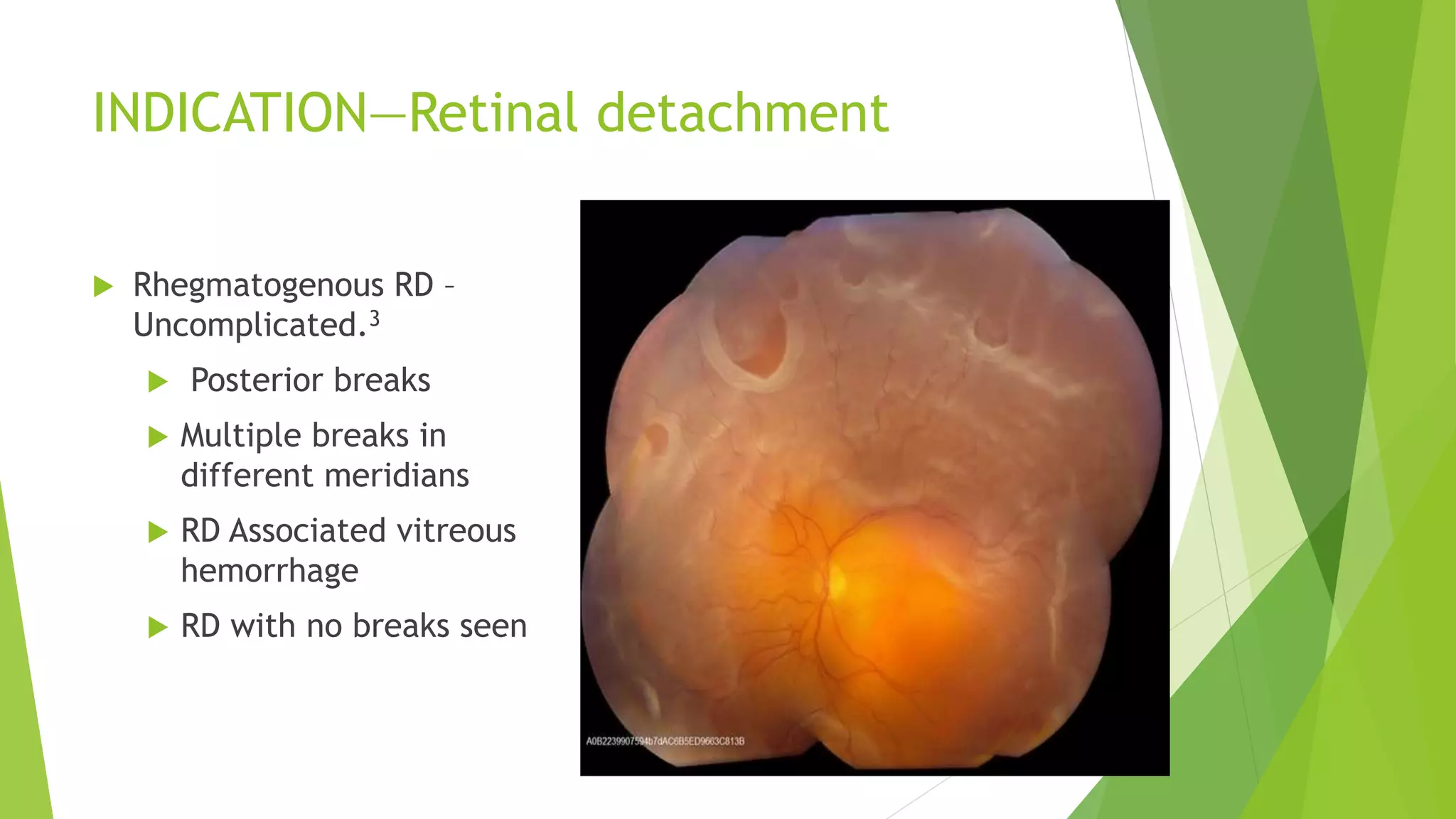 PARS PLANA VITRECTOMY FOR LENS DROP.pptx