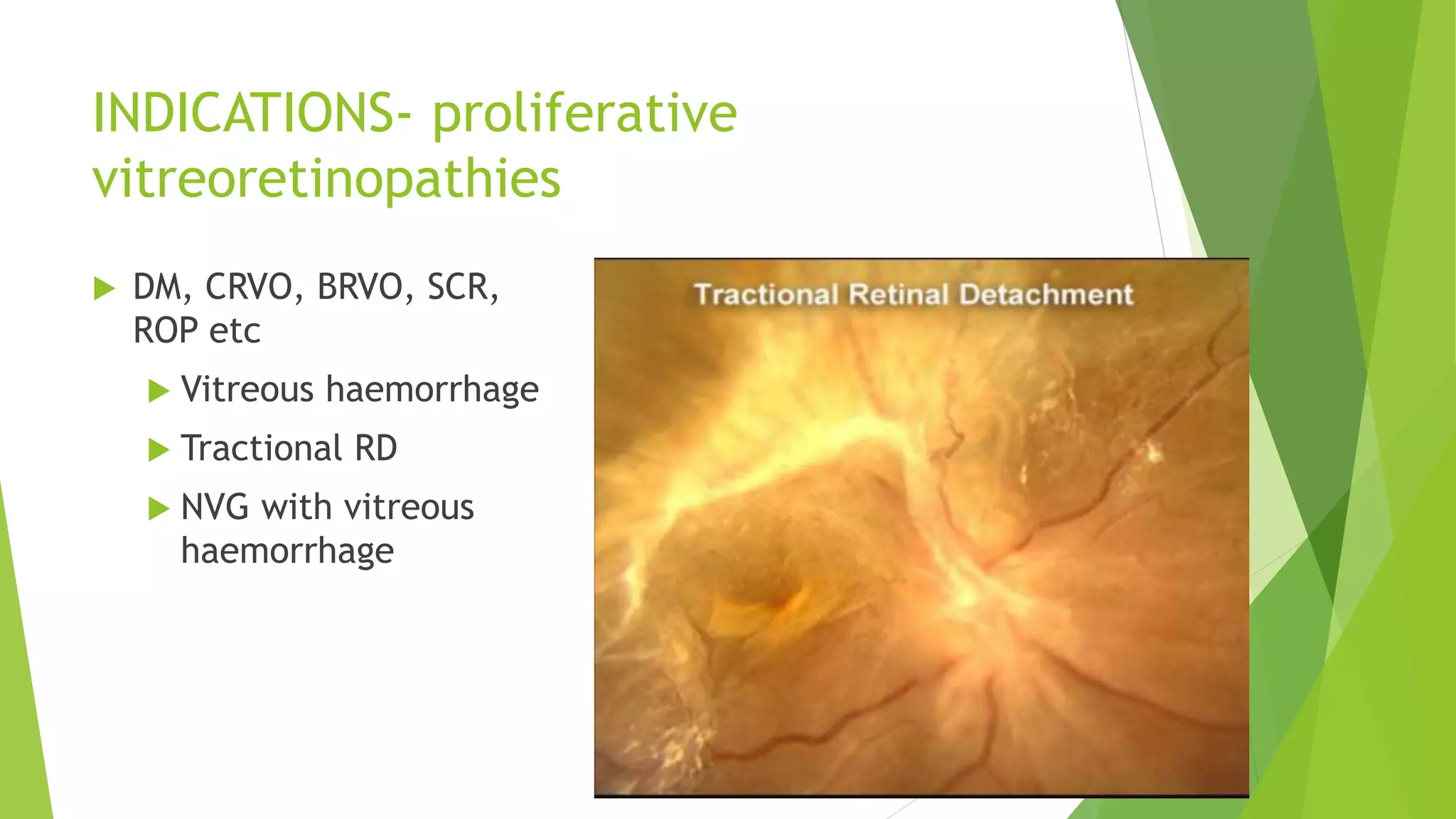 PARS PLANA VITRECTOMY FOR LENS DROP.pptx