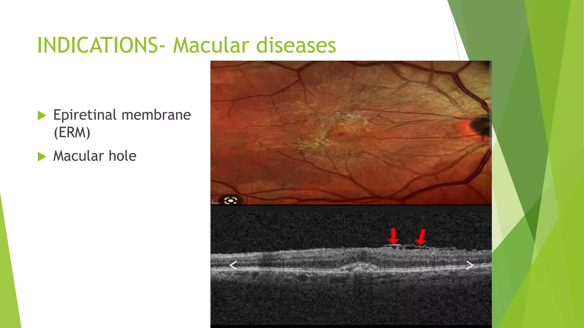 PARS PLANA VITRECTOMY FOR LENS DROP.pptx