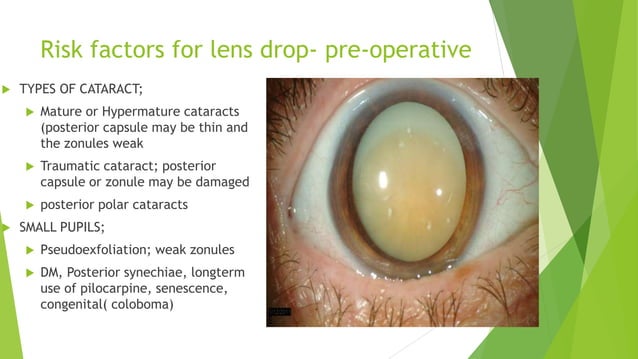 PARS PLANA VITRECTOMY FOR LENS DROP.pptx | Eye and Vision Conditions ...