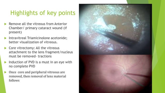 PARS PLANA VITRECTOMY FOR LENS DROP.pptx | Eye and Vision Conditions ...