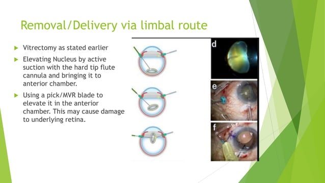 PARS PLANA VITRECTOMY FOR LENS DROP.pptx | Eye and Vision Conditions ...