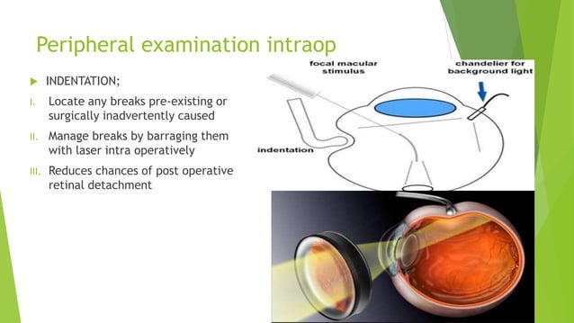 PARS PLANA VITRECTOMY FOR LENS DROP.pptx | Eye and Vision Conditions ...