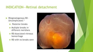 PARS PLANA VITRECTOMY FOR LENS DROP.pptx