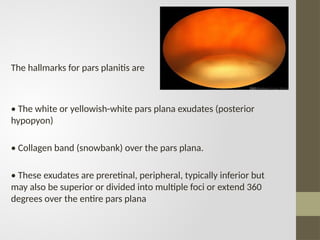 PARS PLANITIS (1).pptx post graduates presentation | PPTX