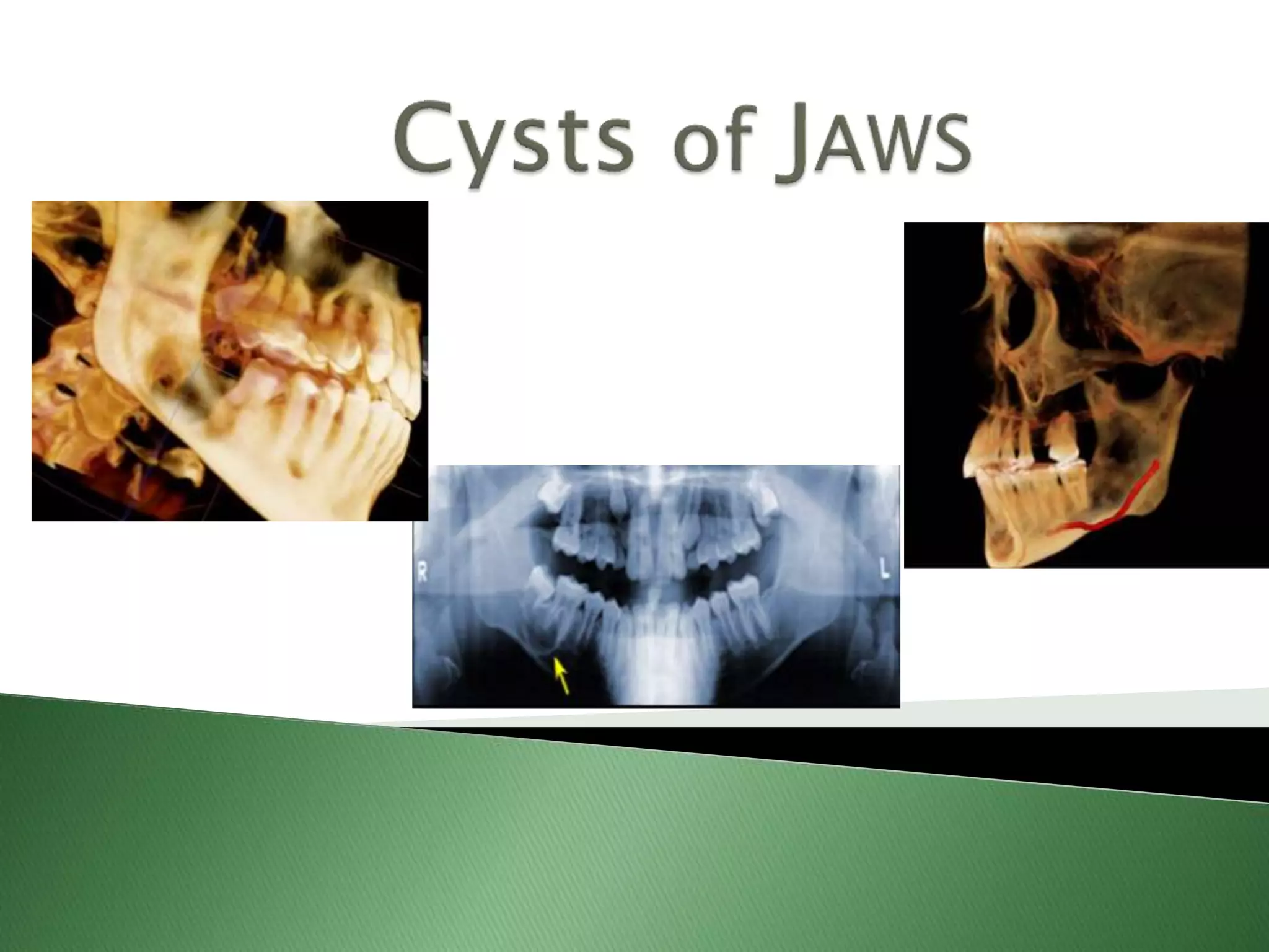 CYSTS OF THE JAW Part 1 | PPTX