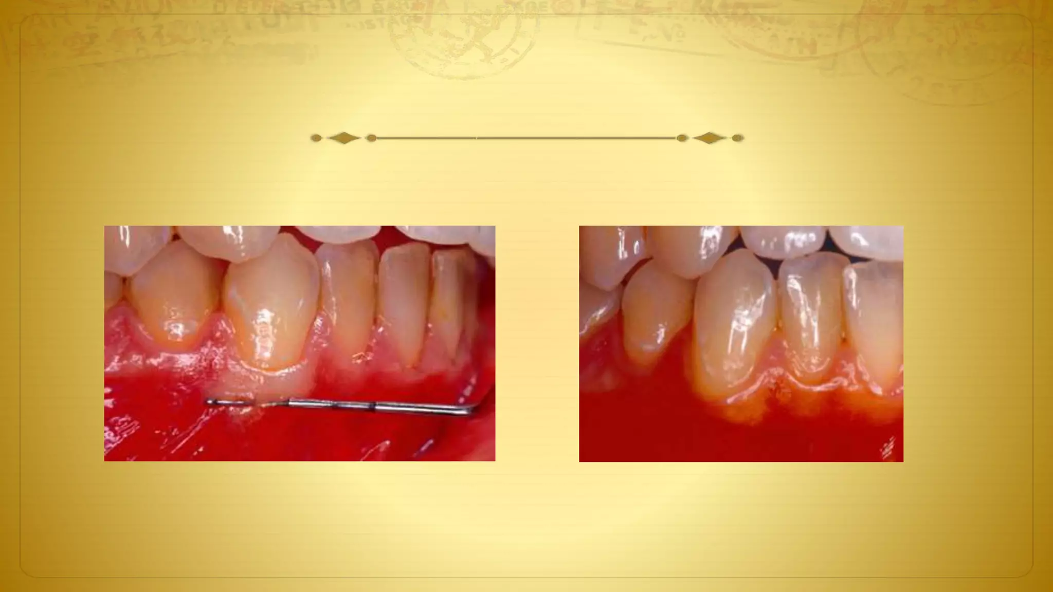 Gingival recession part 2 | PPTX