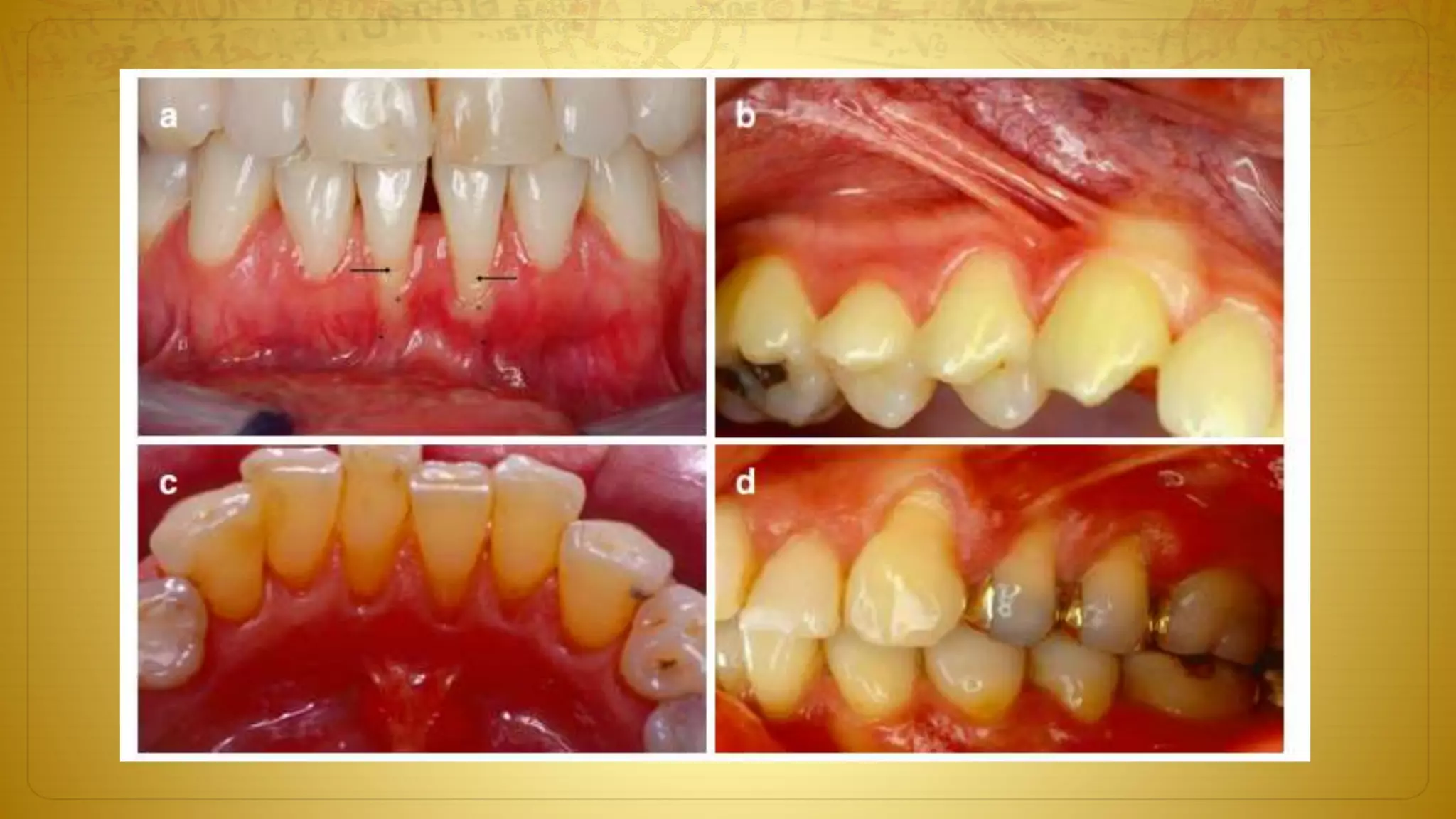 Gingival recession part 2 | PPTX