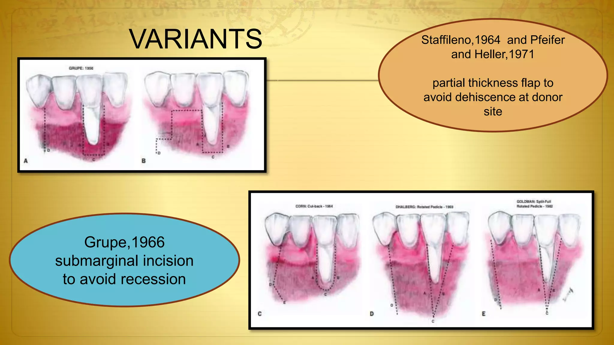 Gingival recession part 2 | PPTX