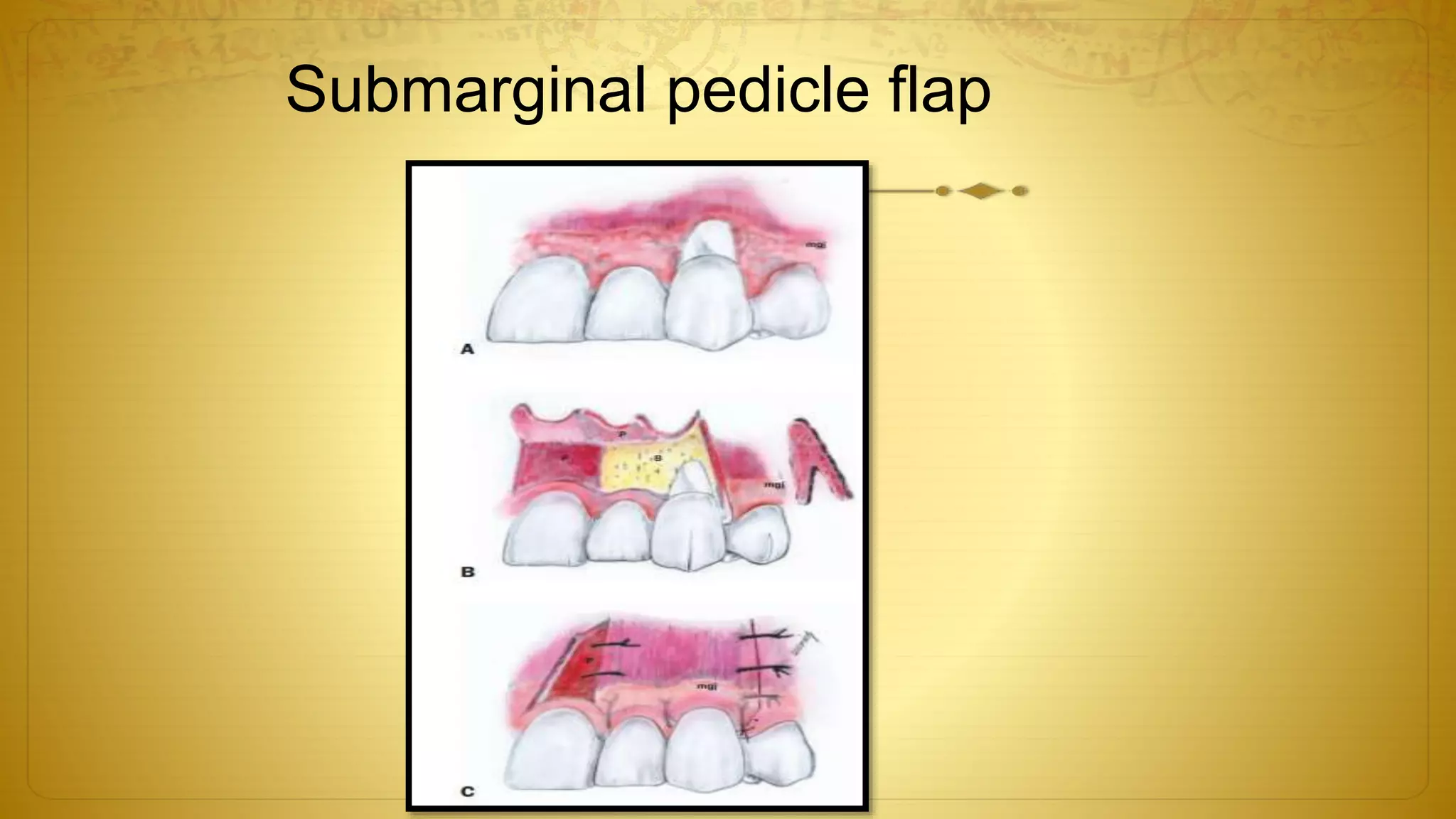Gingival recession part 2 | PPTX