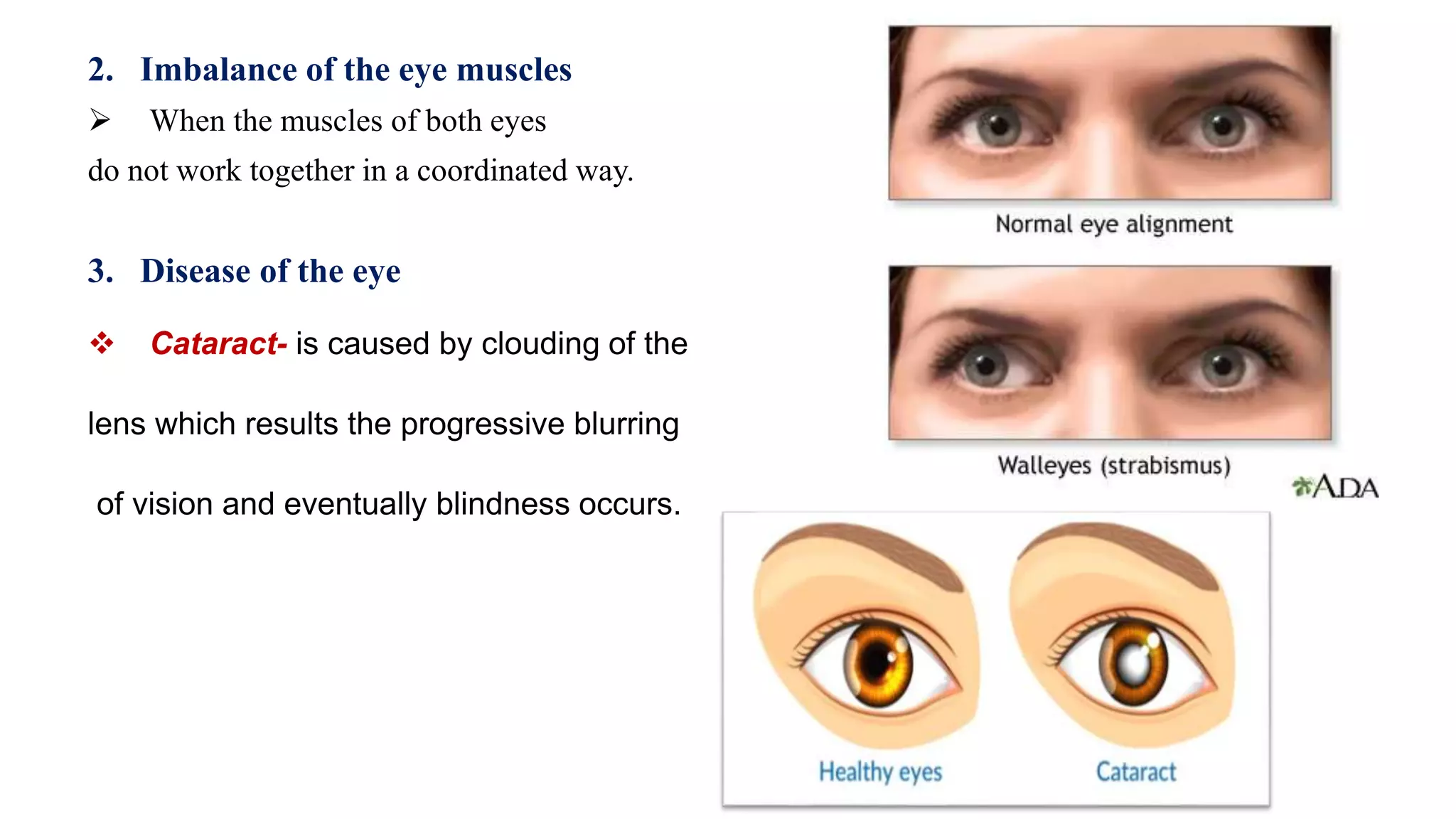 Blindness and Low Vision | PPTX